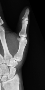 Bennett Fracture (-dislocation) - xray school